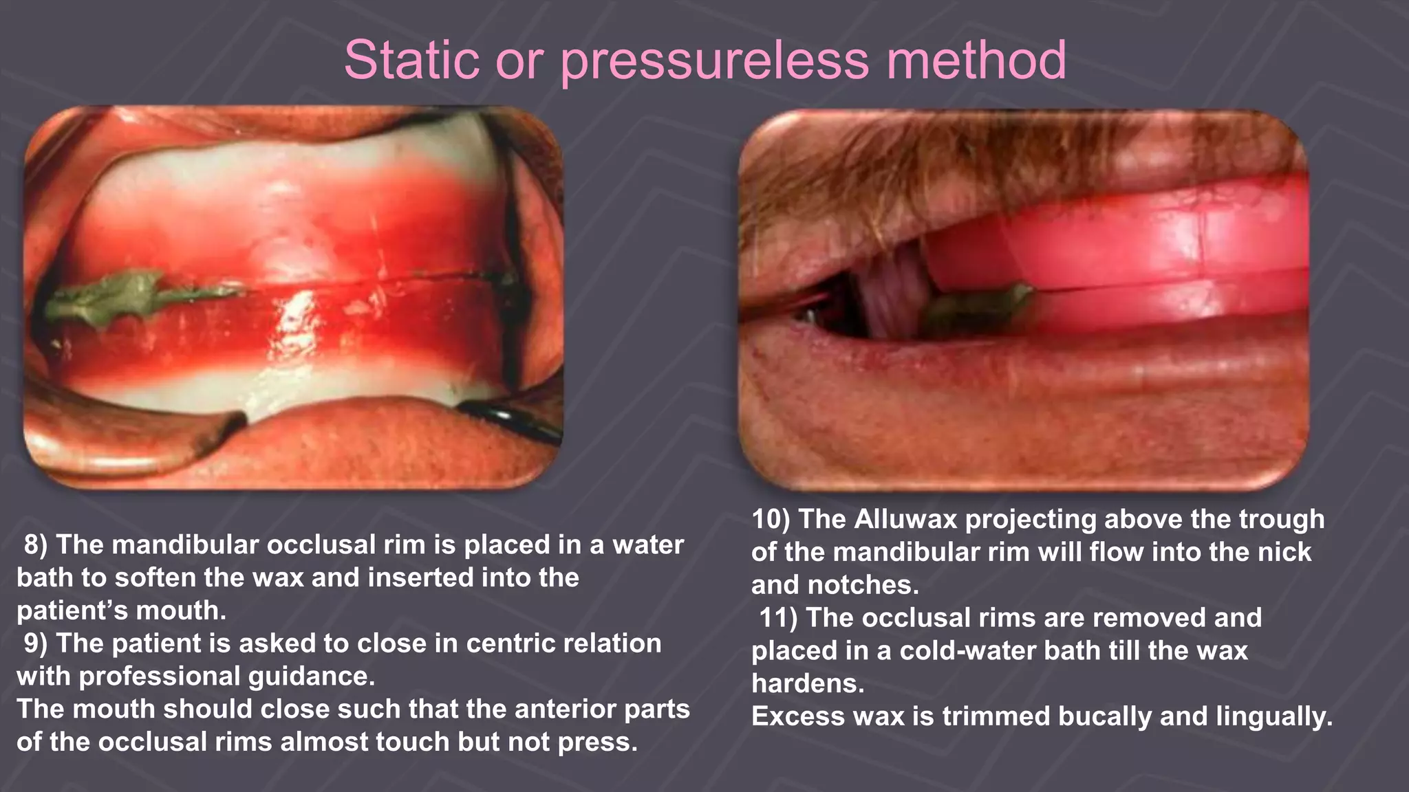 Check bite technique | PDF