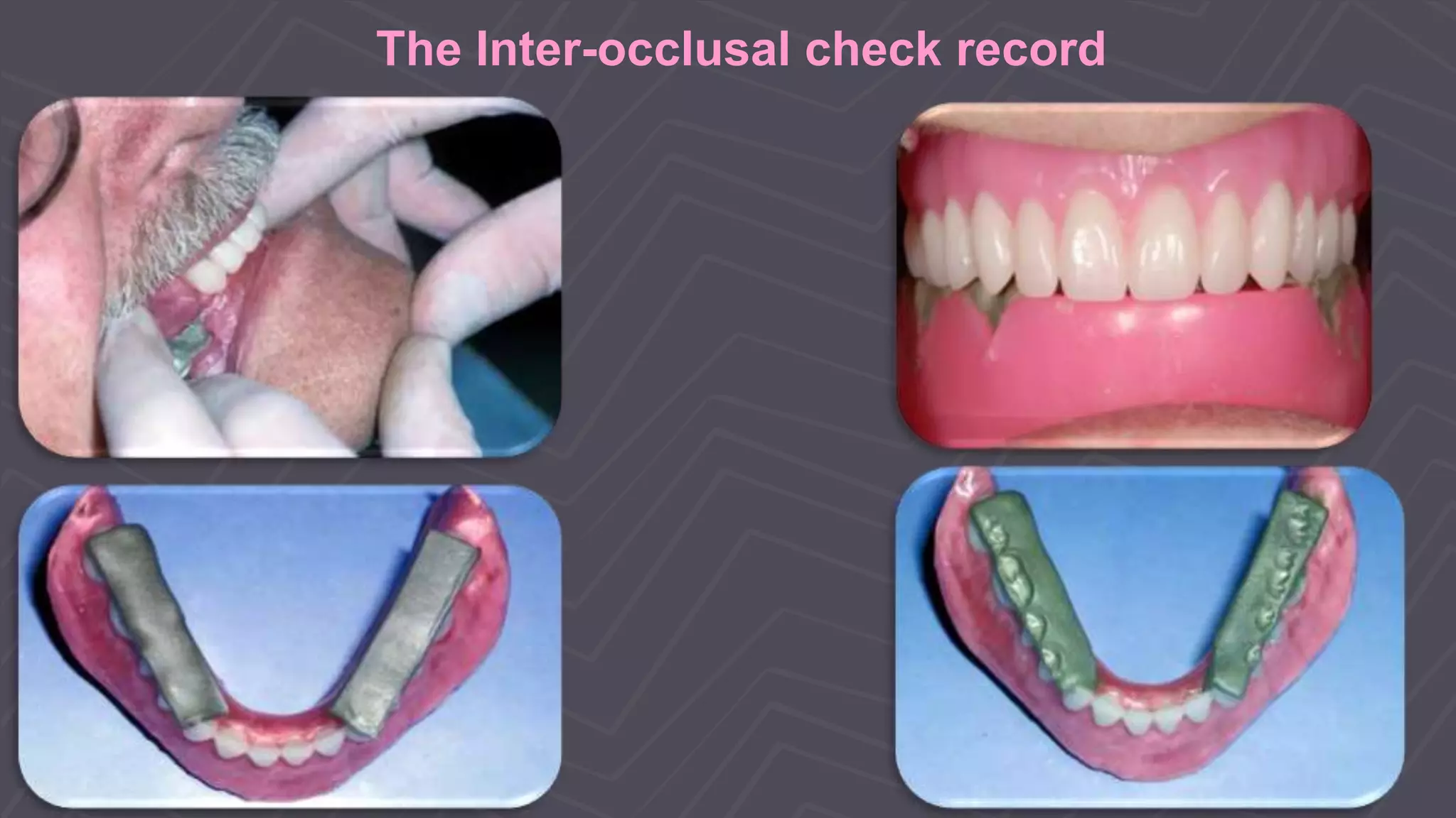 Check bite technique | PDF