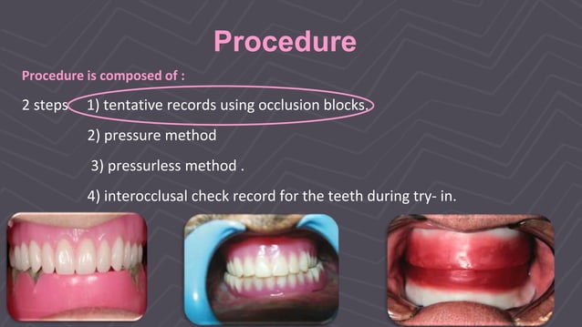 Check bite technique | PDF