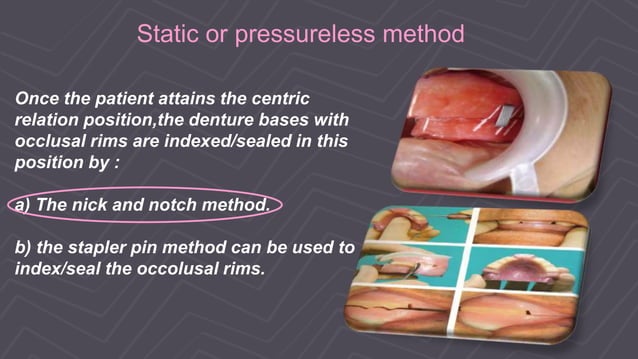 Check bite technique | PDF