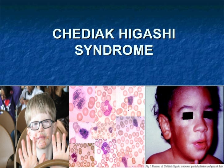 Chediak higashi syndrome, Phenylketonuria, Dentinogenesis Imperfecta