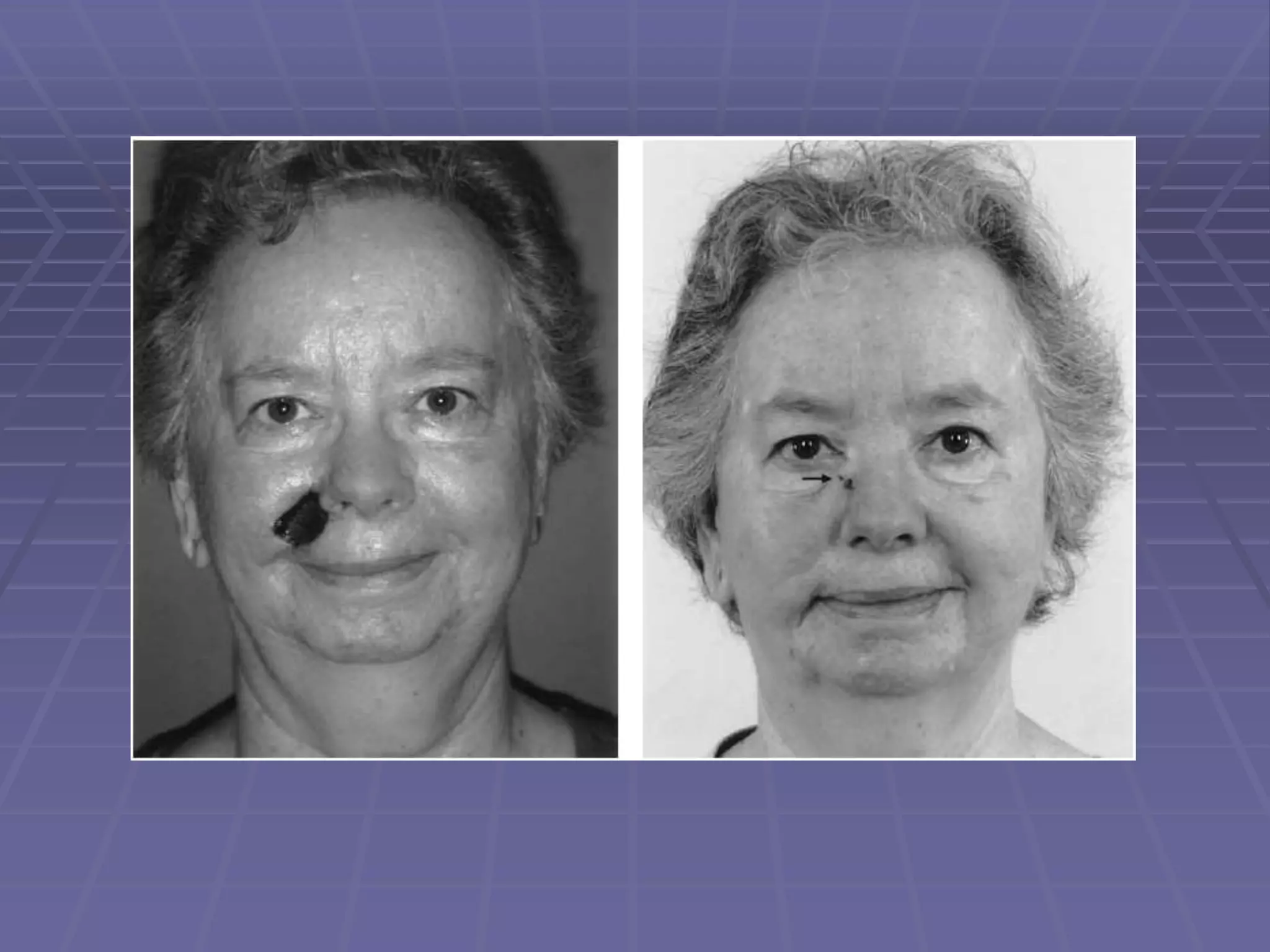 cheek-reconstruction-ppt.ppt | Death, Injury, or Military Conflict ...