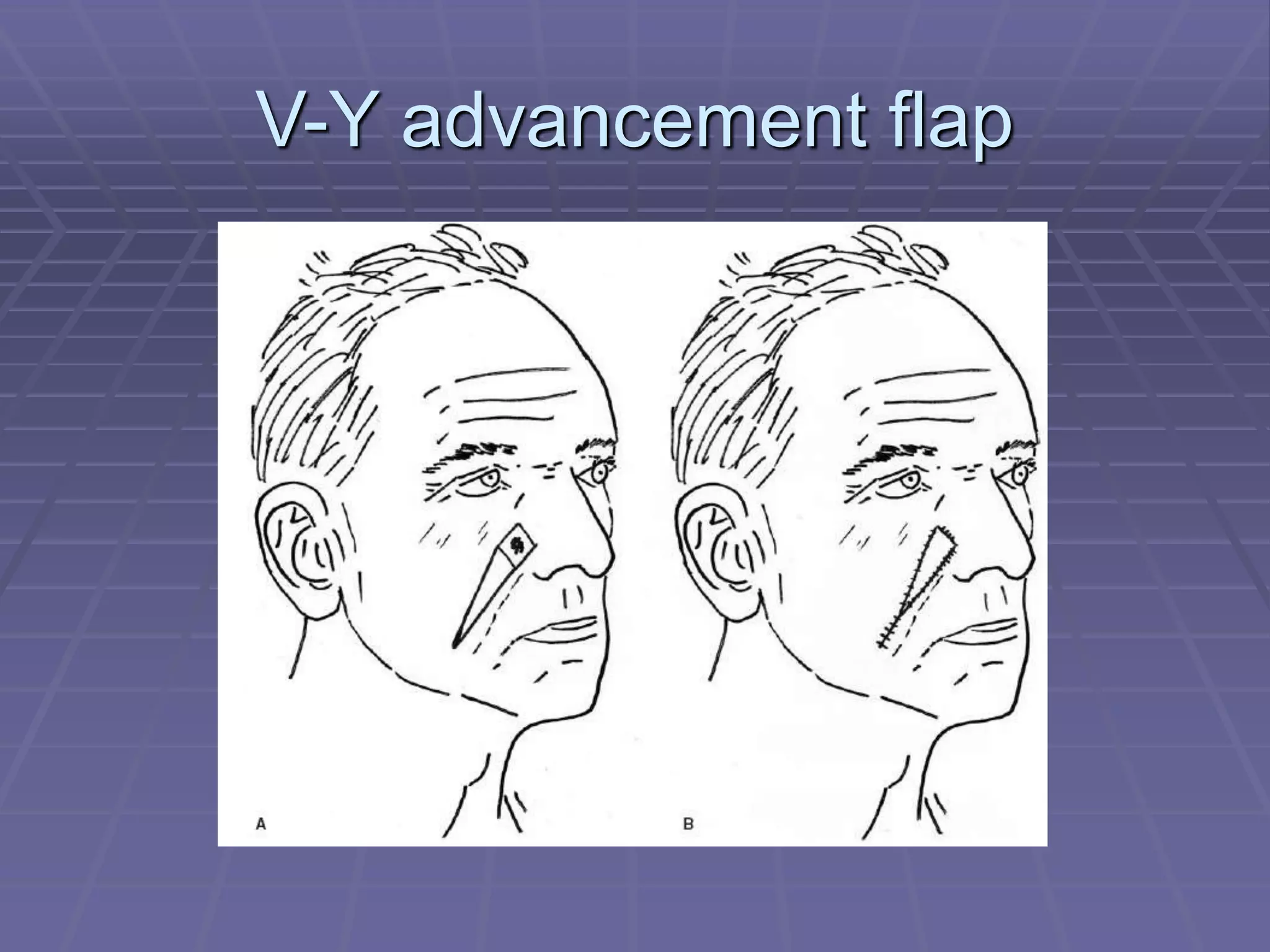 cheek-reconstruction-ppt.ppt | Death, Injury, or Military Conflict ...