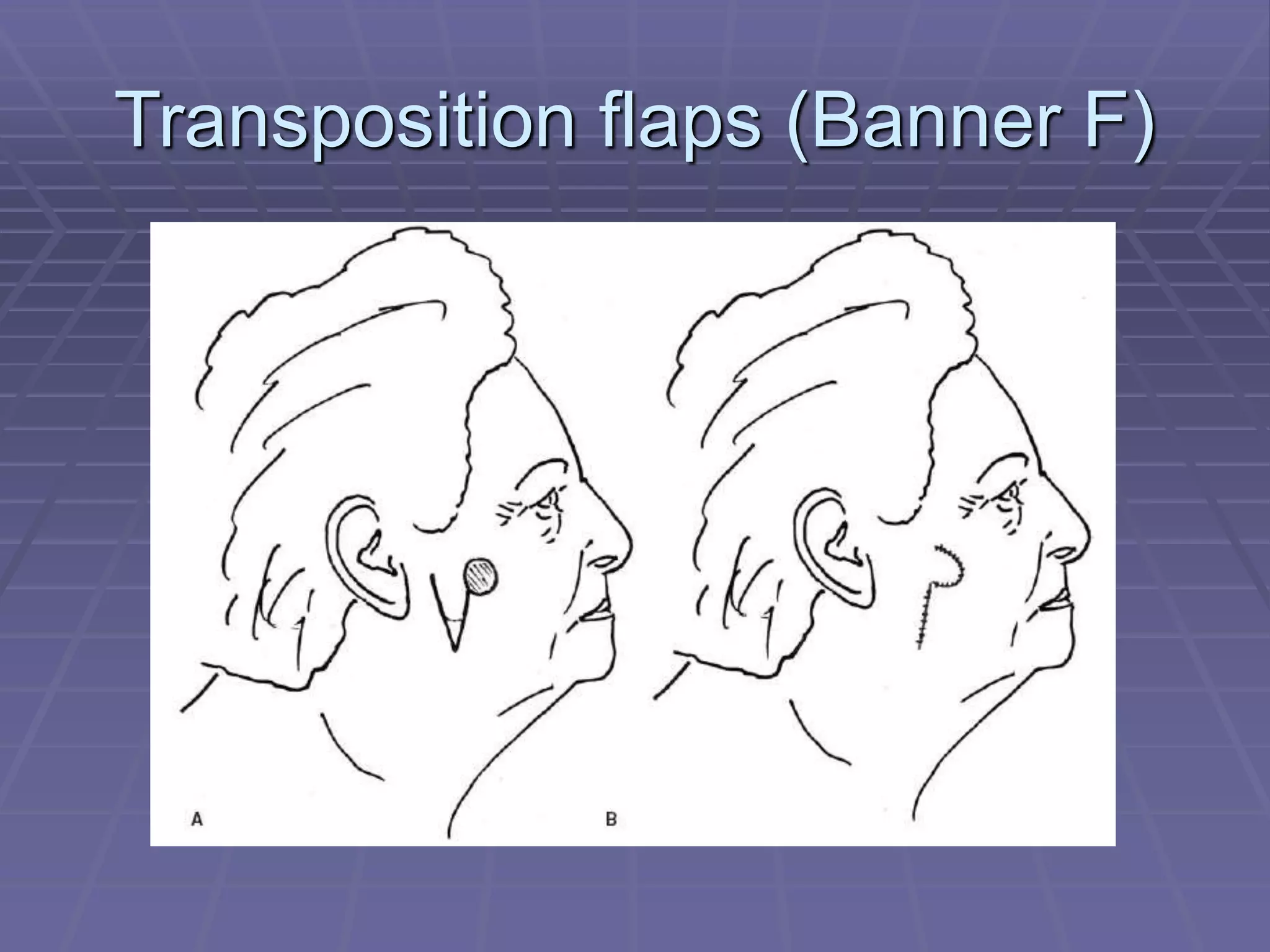 cheek-reconstruction-ppt.ppt | Death, Injury, or Military Conflict ...