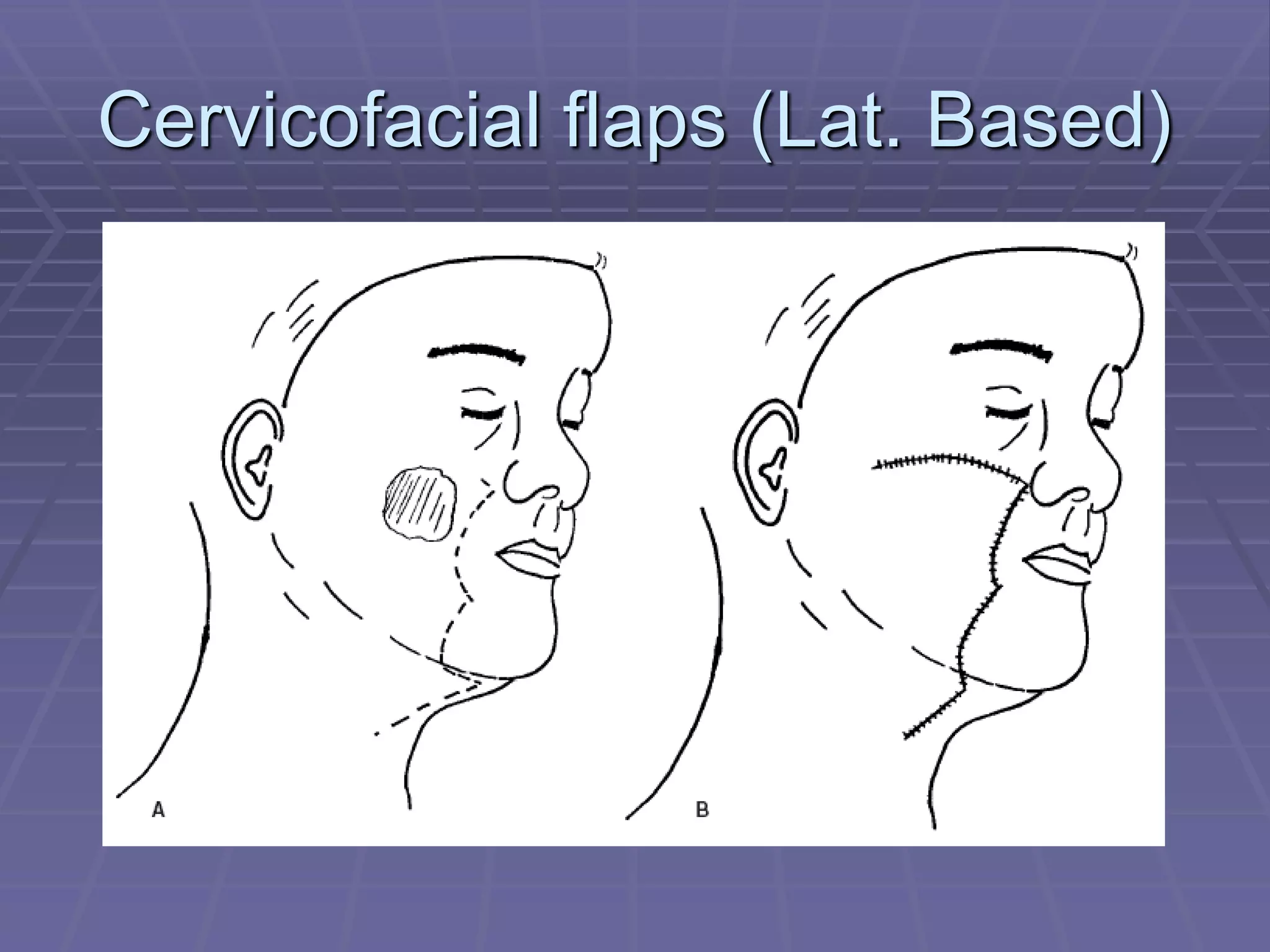 cheek-reconstruction-ppt.ppt | Death, Injury, or Military Conflict ...