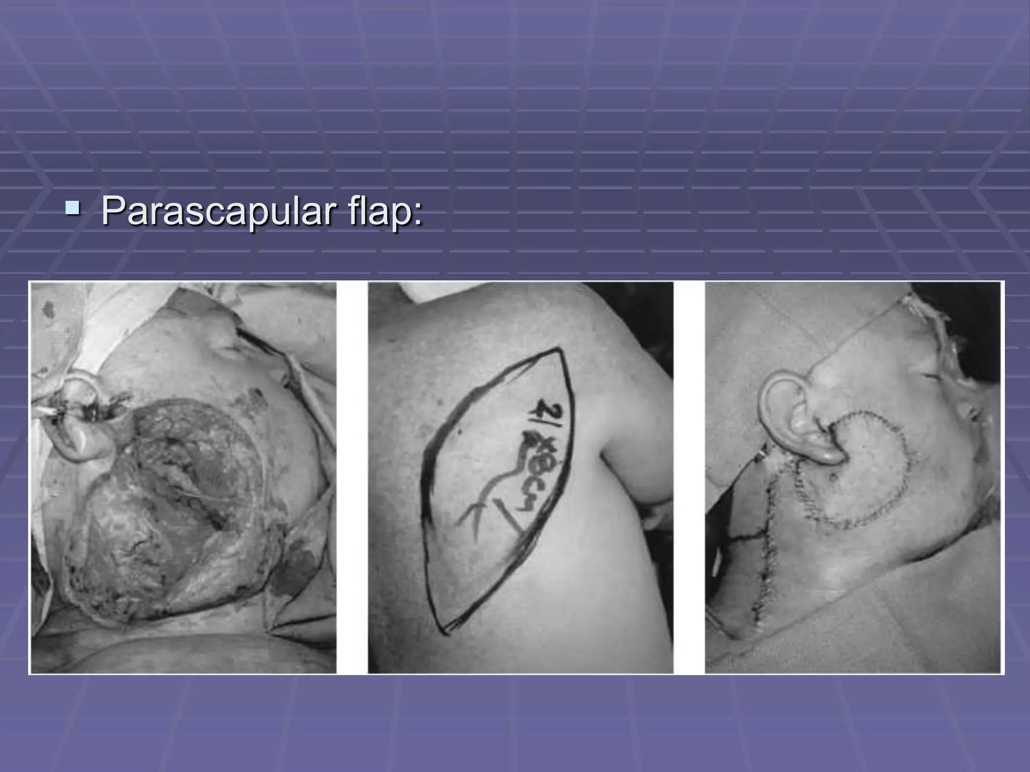 cheek-reconstruction-ppt.ppt | Death, Injury, or Military Conflict ...