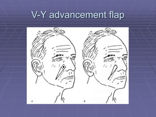 cheek-reconstruction-ppt.ppt