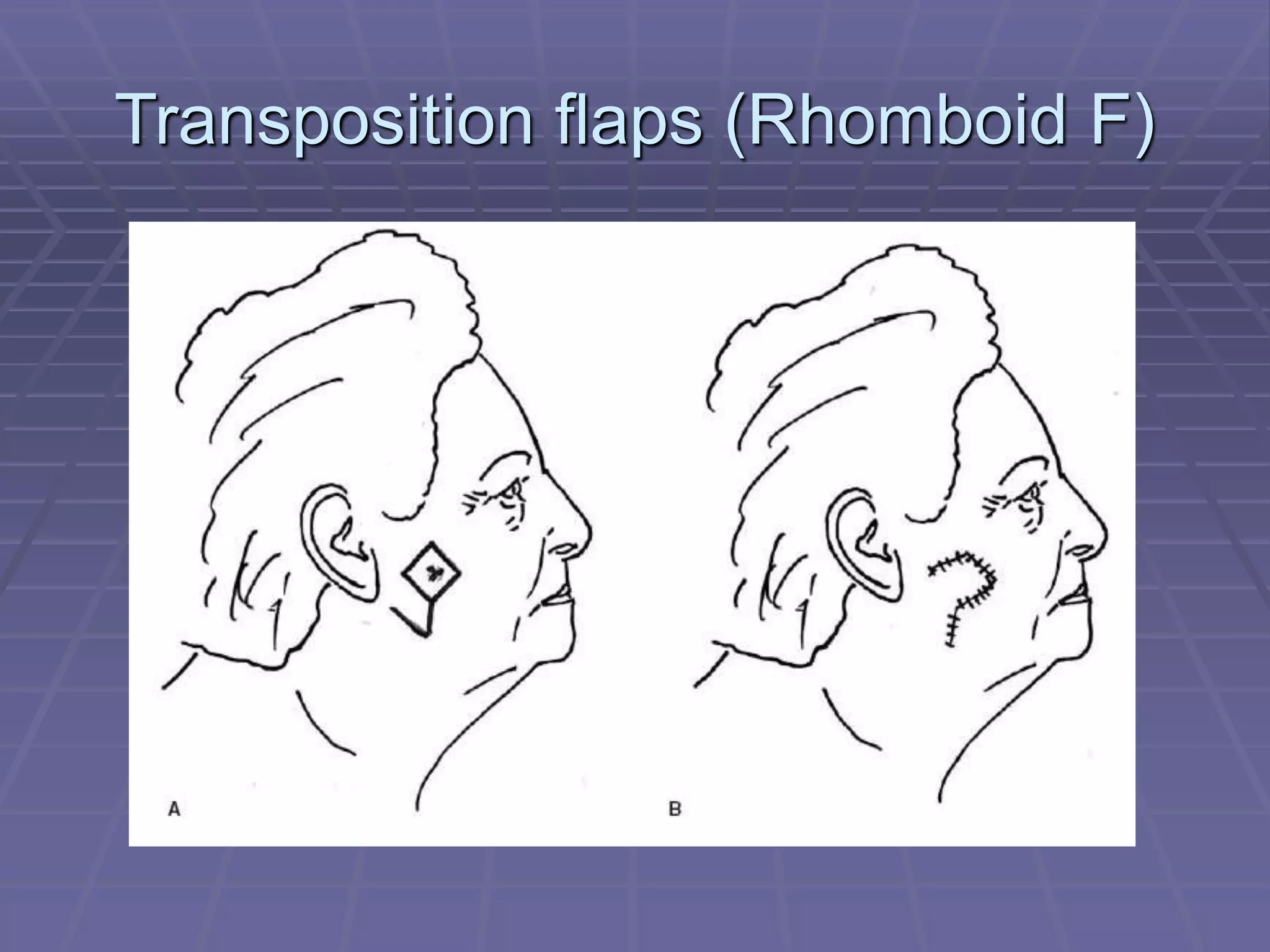 cheek-reconstruction-ppt.ppt