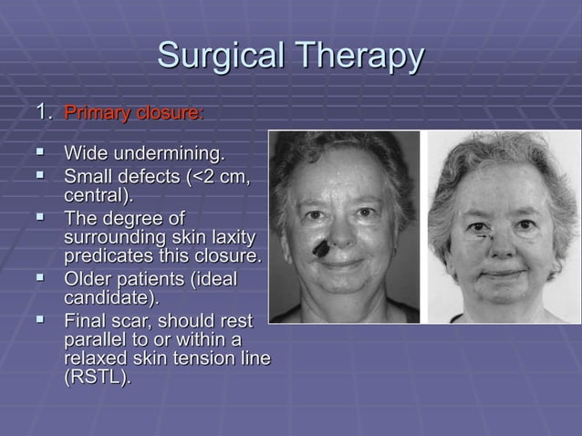 cheek-reconstruction-ppt.ppt