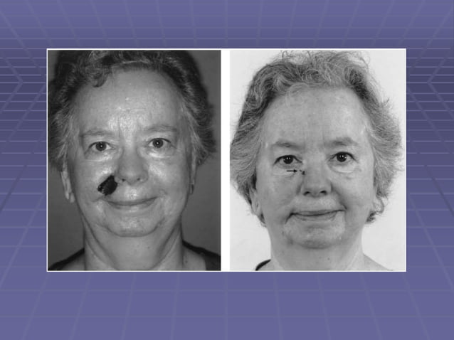 cheek-reconstruction-ppt.ppt