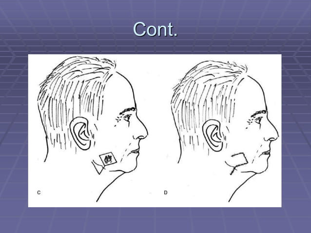 cheek-reconstruction-ppt.ppt