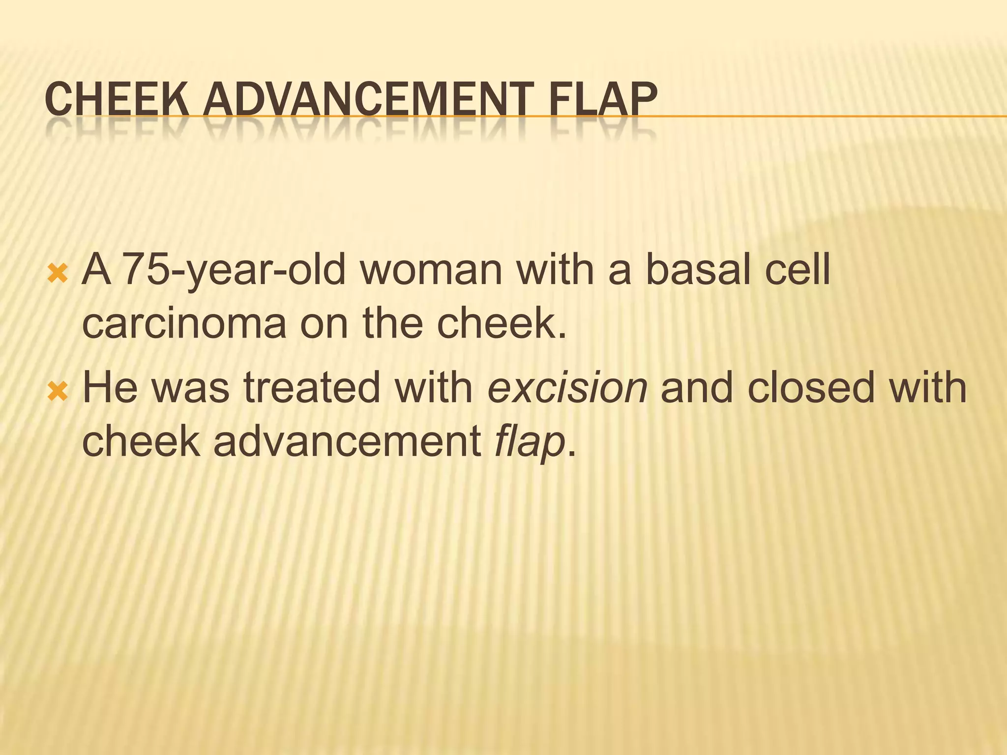 Cheek Advancement Flap | PPTX