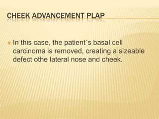Cheek Advancement Flap | PPTX