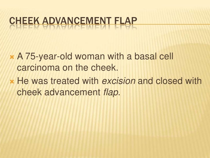 Cheek Advancement Flap