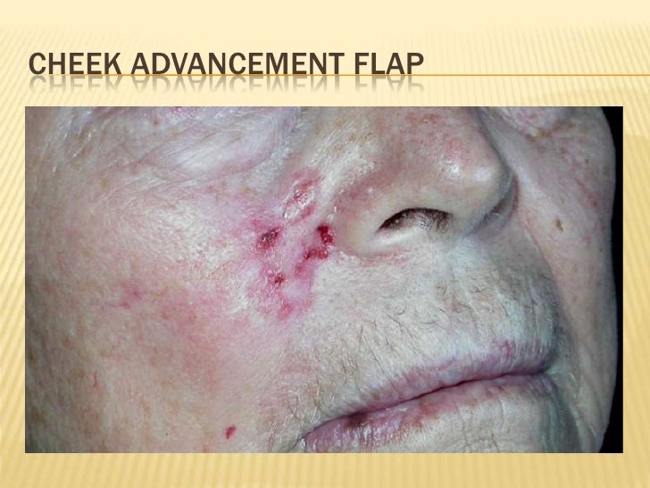 Cheek Advancement Flap