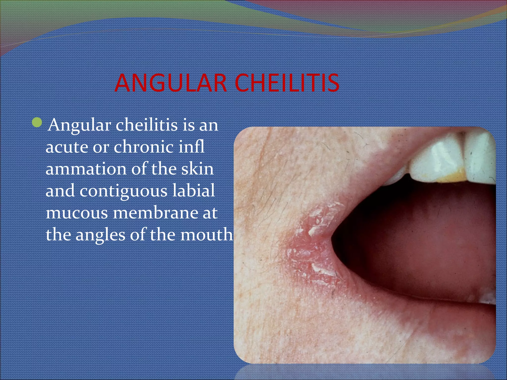 Cheilitis | PPT