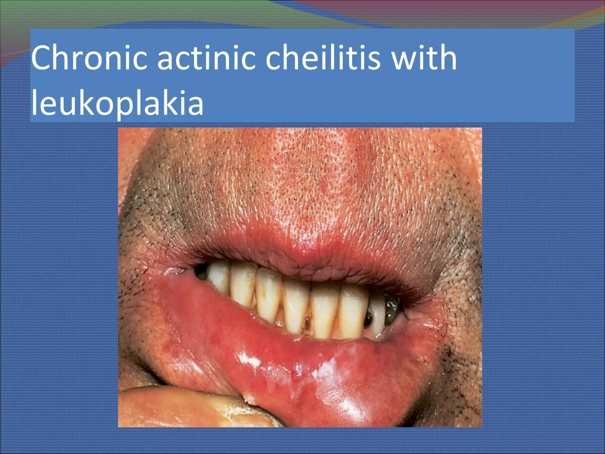 Cheilitis | PPT