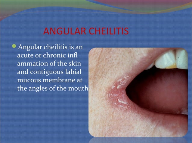 Cheilitis | PPT | Dental Health | Diseases and Conditions