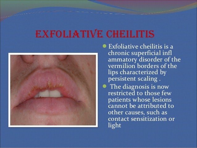 Exfoliative Cheilitis Causes Treatment Prevention And More