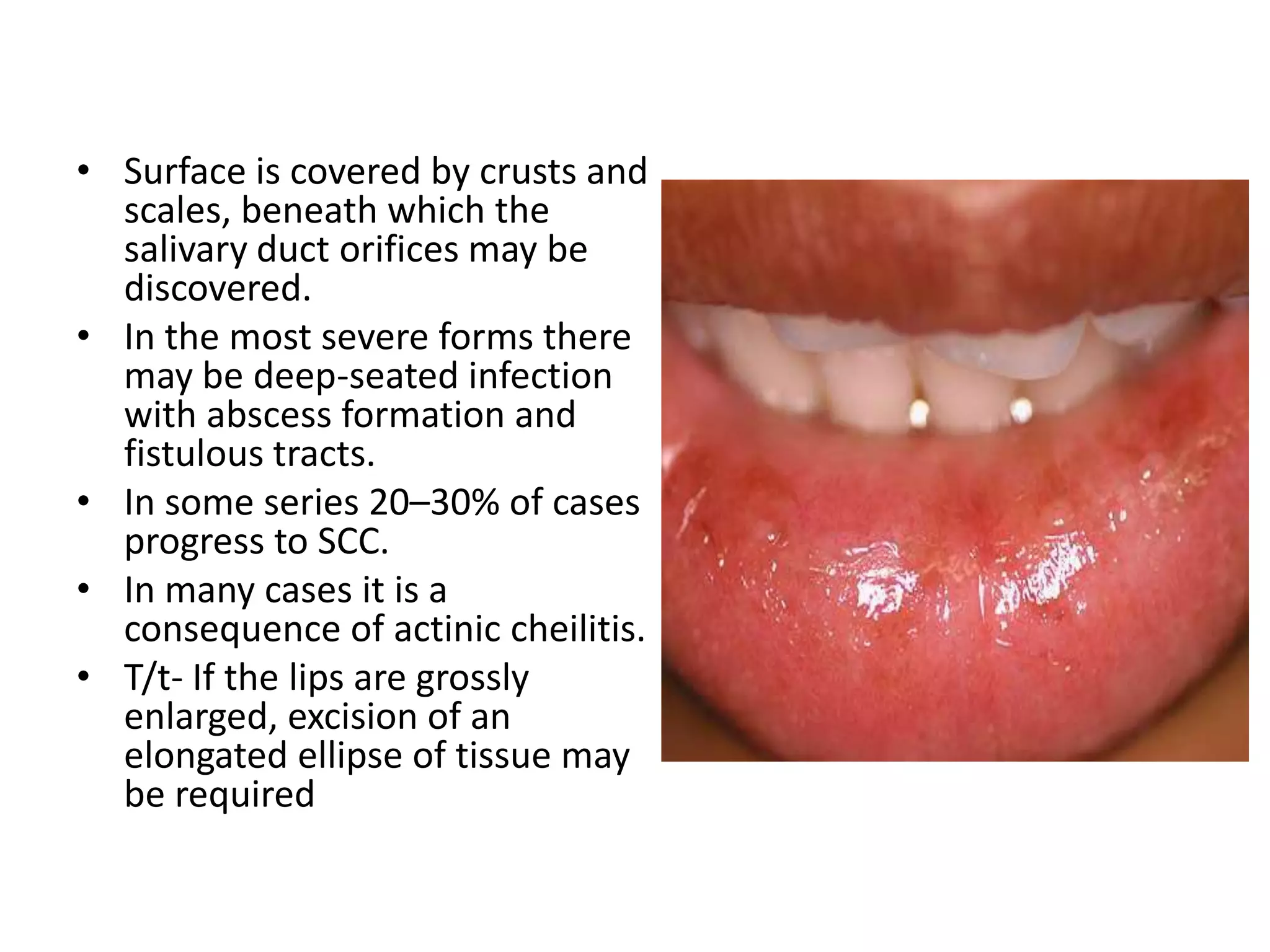 Cheilitis | PPTX