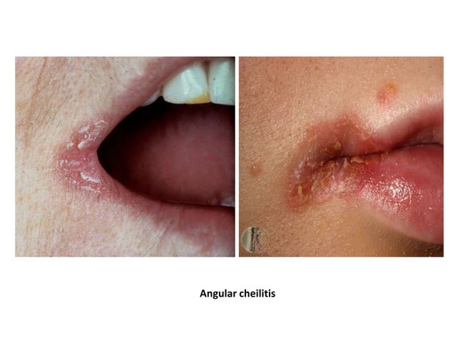 Cheilitis | PPTX