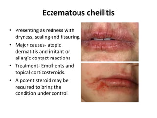 Cheilitis | PPTX