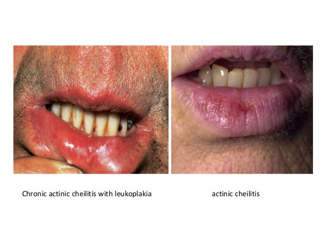 Cheilitis