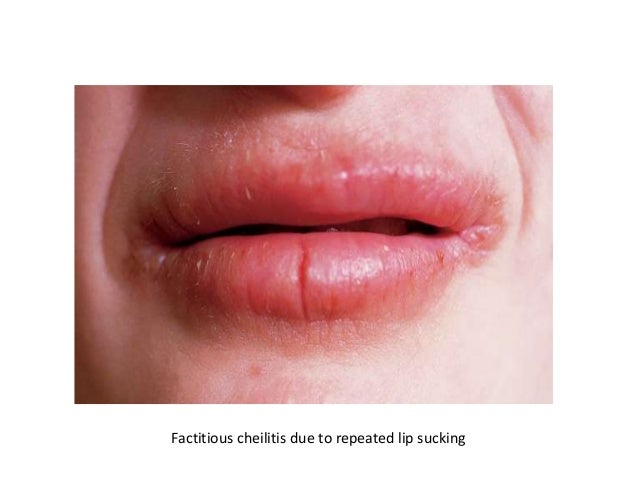 Factitious Cheilitis Disorders Of The Mucous Membranes | Plastic