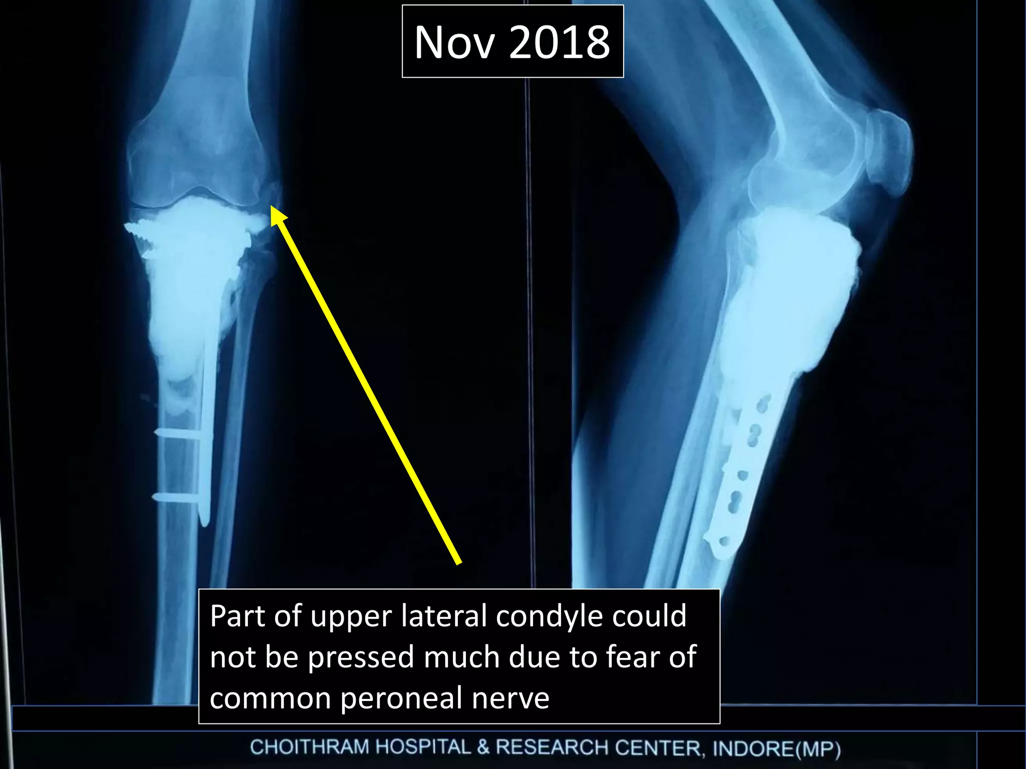 GCT Upper Tibial Pathological Fracture | PPT