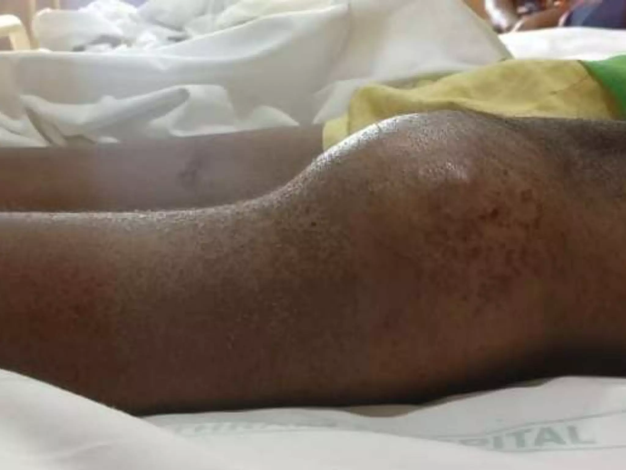 GCT Upper Tibial Pathological Fracture | PPT