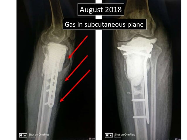 GCT Upper Tibial Pathological Fracture | PPT