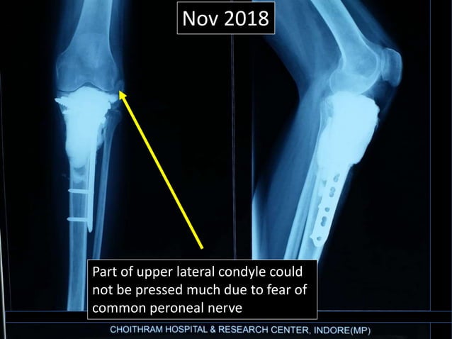 GCT Upper Tibial Pathological Fracture | PPT