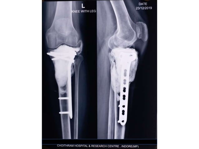 GCT Upper Tibial Pathological Fracture | PPT