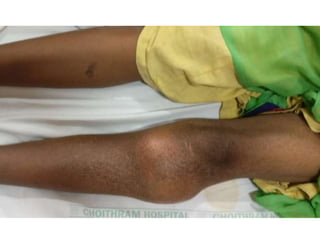 GCT Upper Tibial Pathological Fracture | PPT