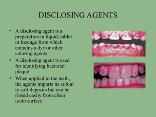 chemical-plaque-control2345567754211.ppt