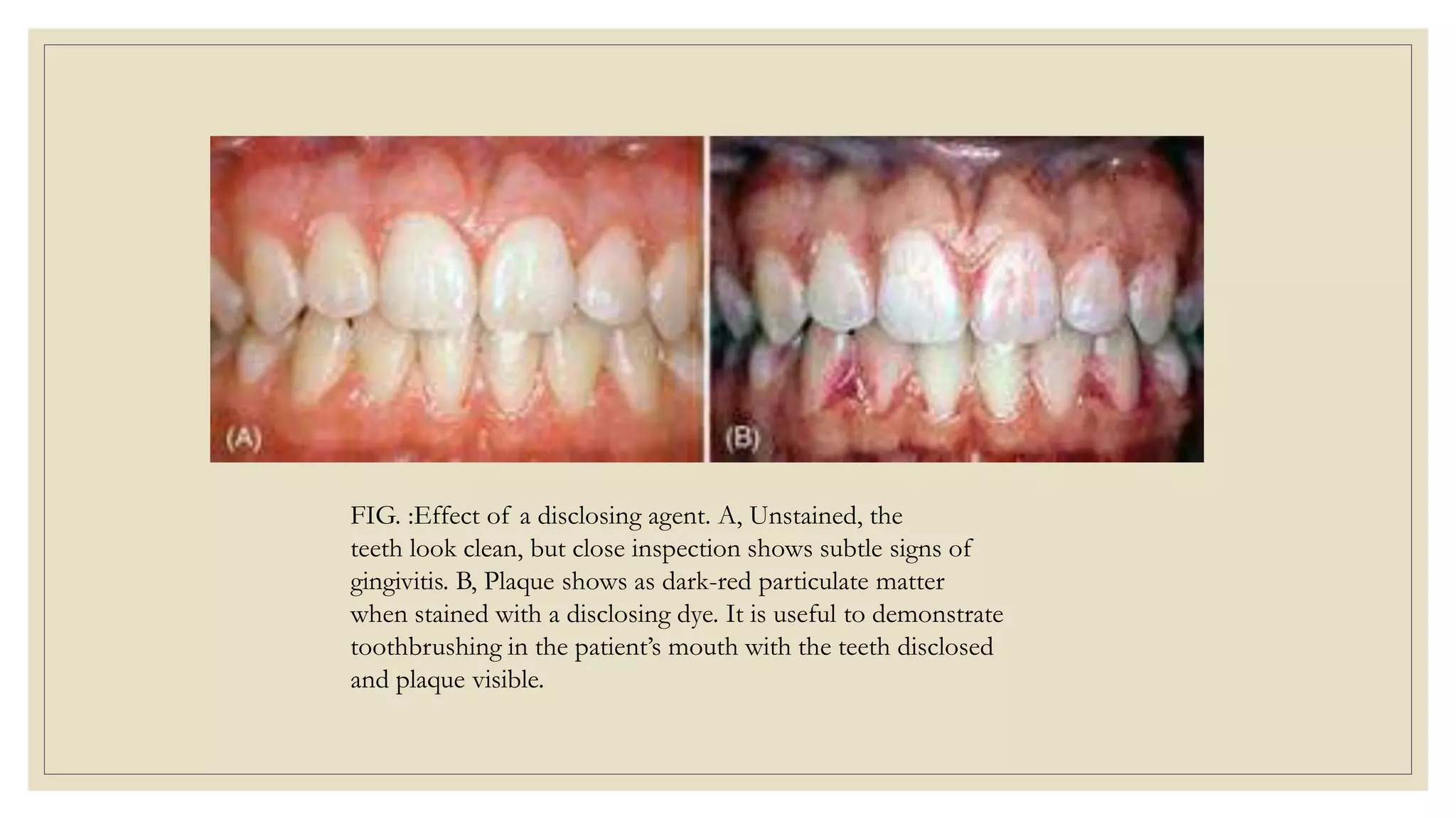 Chemical plaque control methods | PPTX