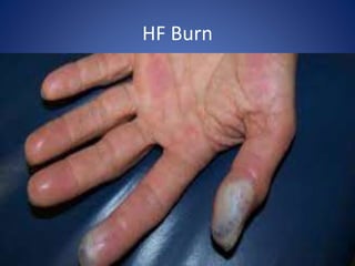 Hydrochloric Acid Burn Hand