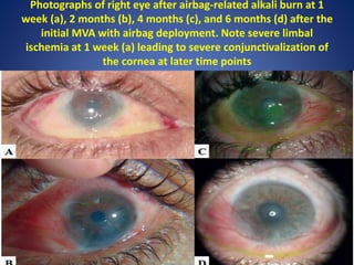 Sodium Hydroxide Burn