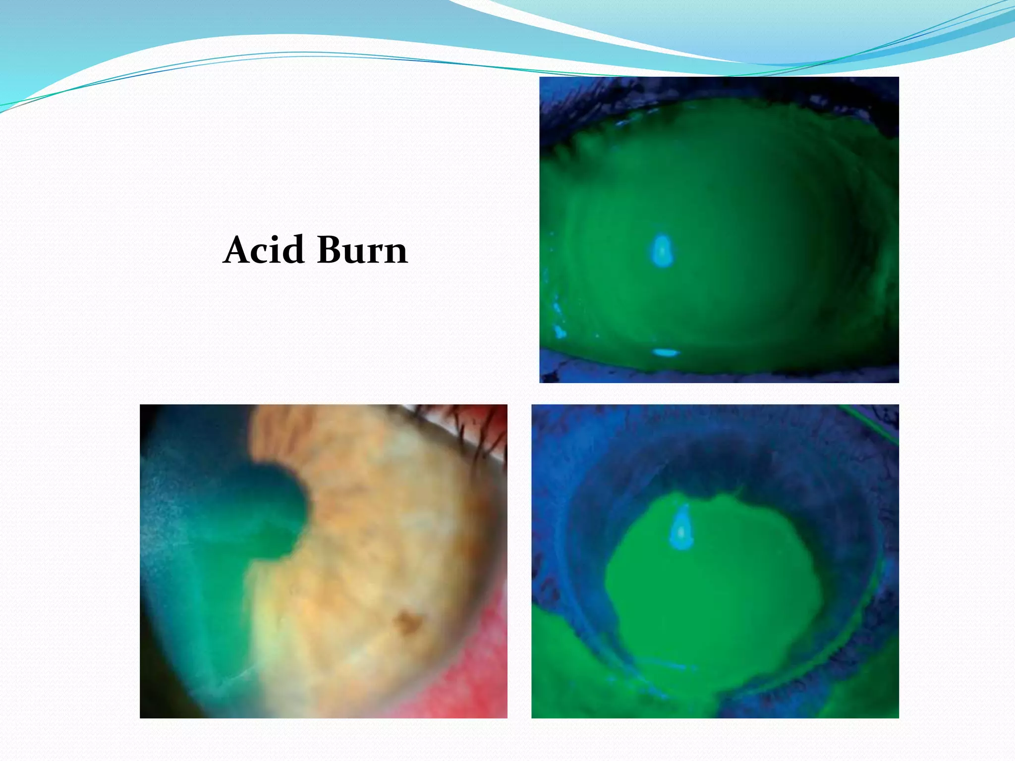 Chemical eye trauma, By Dr. Safaa Refaat | PPTX