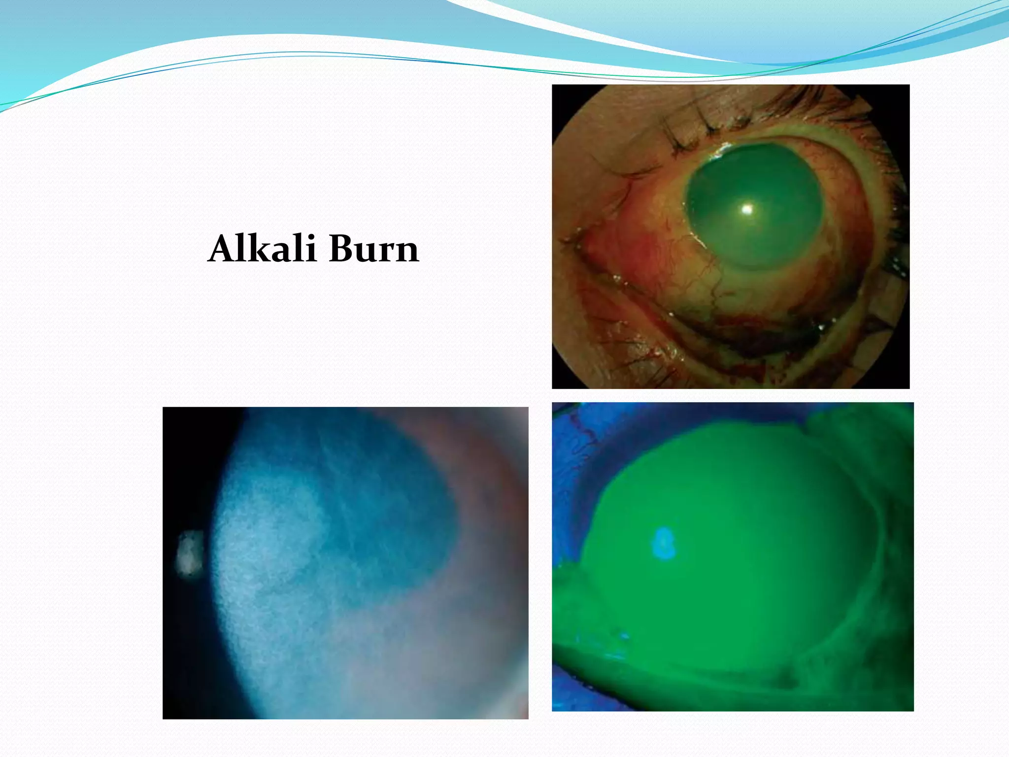 Chemical eye trauma, By Dr. Safaa Refaat | PPTX