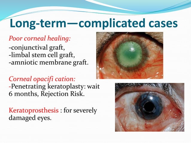 Chemical eye trauma, By Dr. Safaa Refaat | PPT