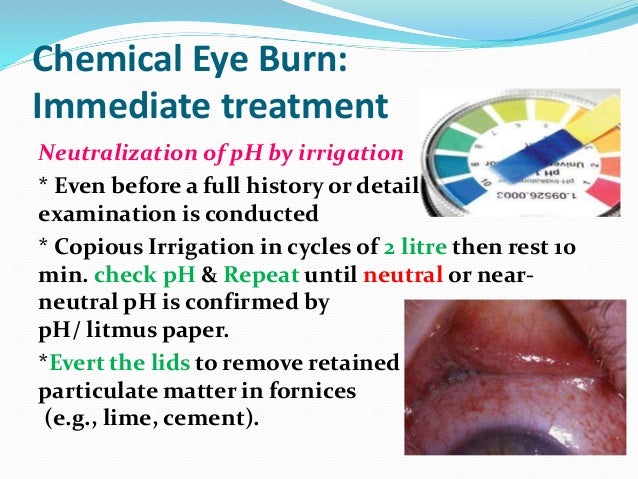 Chemical eye trauma, By Dr. Safaa Refaat