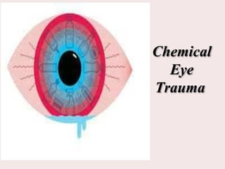 Chemical eye trauma | PPTX