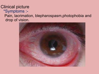 Chemical eye trauma | PPTX