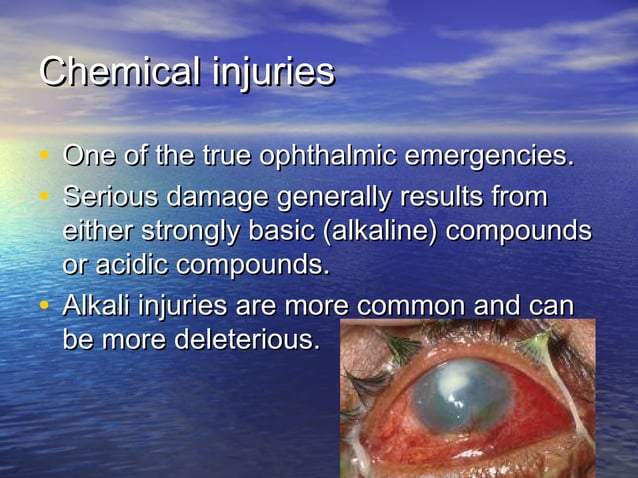 Ocular chemical injuries | PPT