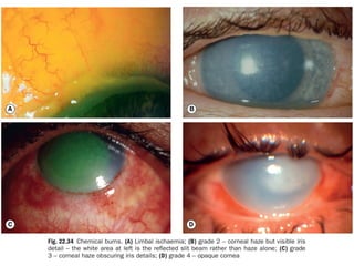 nON MECHANICAL OCULAR INJURIES .pptx