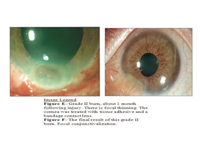 nON MECHANICAL OCULAR INJURIES .pptx | First Aid | Injuries