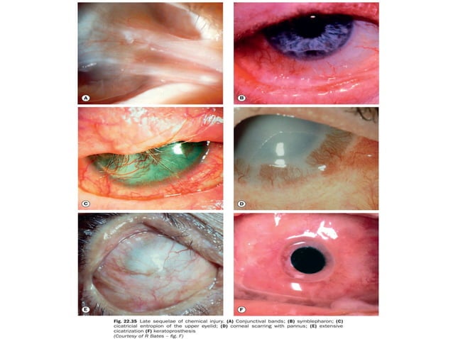 nON MECHANICAL OCULAR INJURIES .pptx | First Aid | Injuries