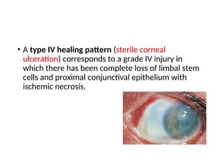 CHEMICAL INJURIES of the EYE and its management | PPT