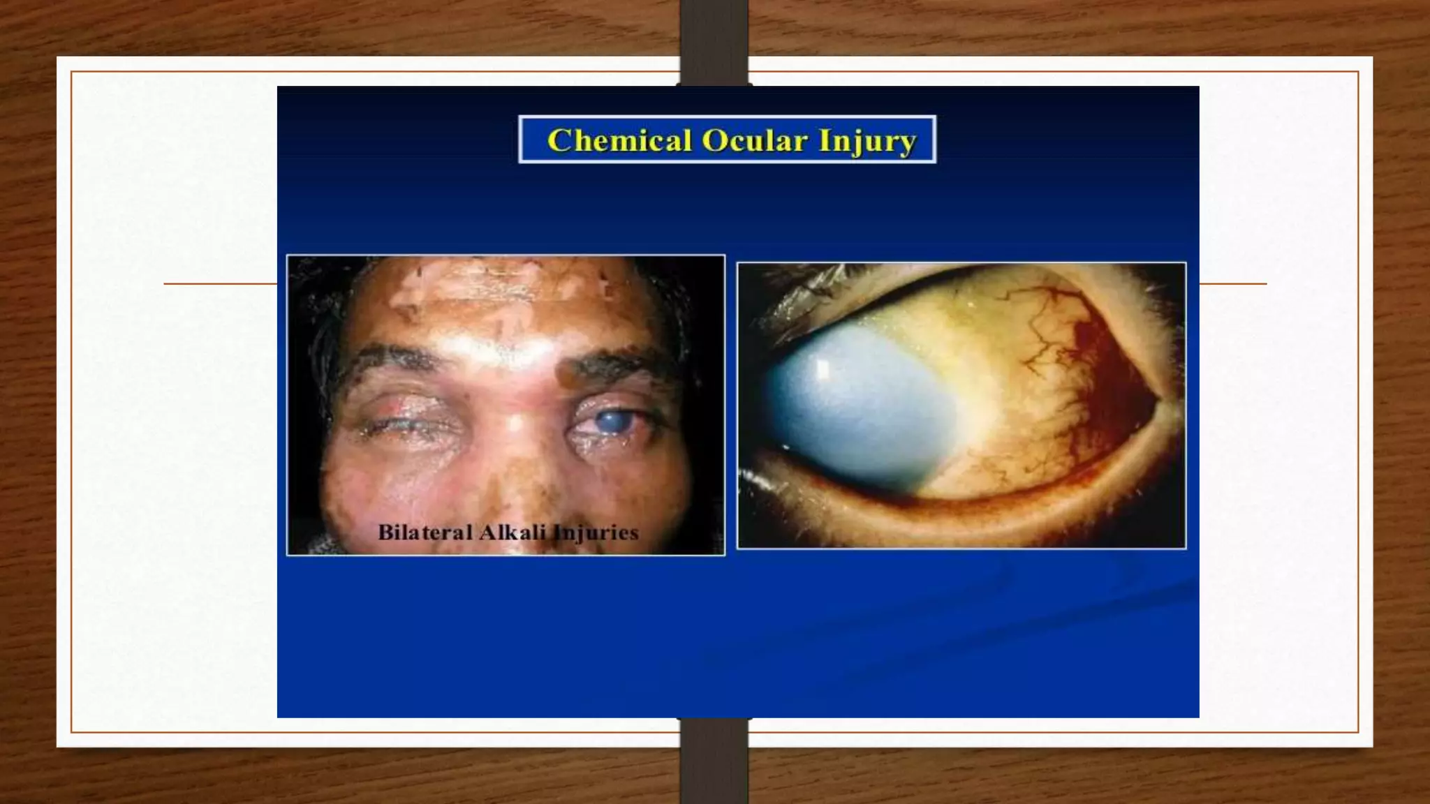 Chemical injuries of the eye | PPTX